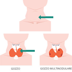 Gozzo tiroideo - Dr. Domenico Vendettuoli